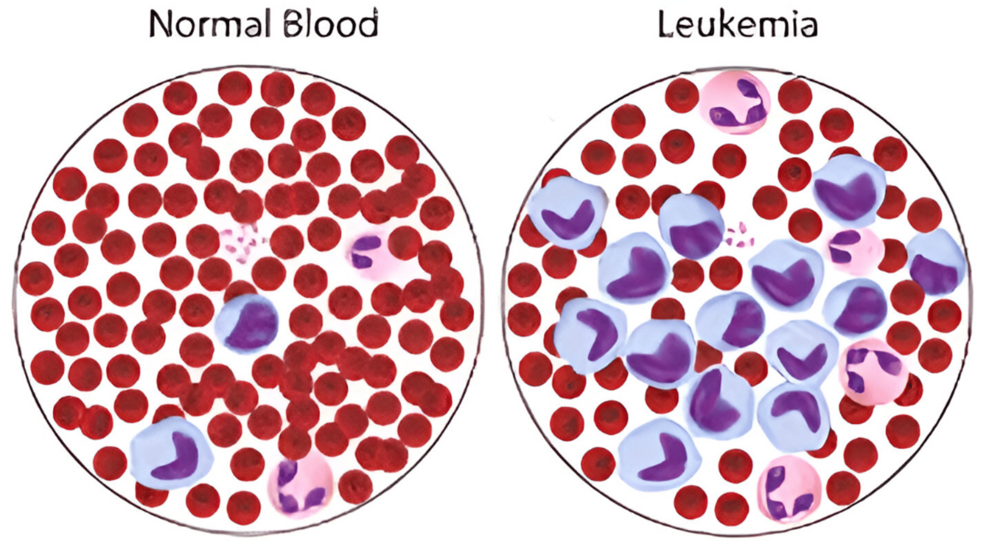 Feature-Driven Acute Lymphoblastic Leukemia Detection From Blood Smears ...